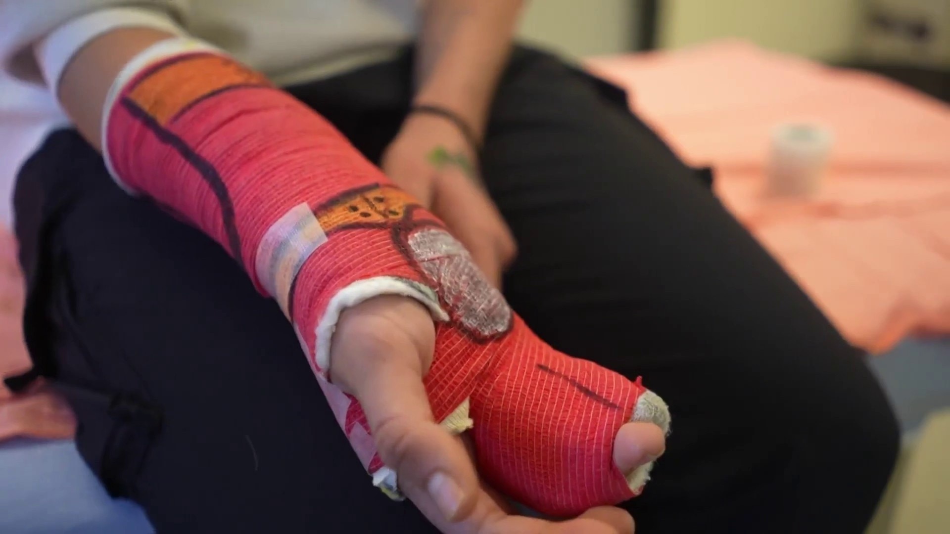 Watch TODAY Excerpt: This medical worker puts smiles on young patients faces with cast art ...
